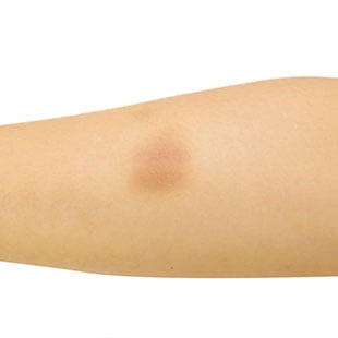 ¿Qué son los moretones y cómo ocultarlos? | Jabones Kleenex® México